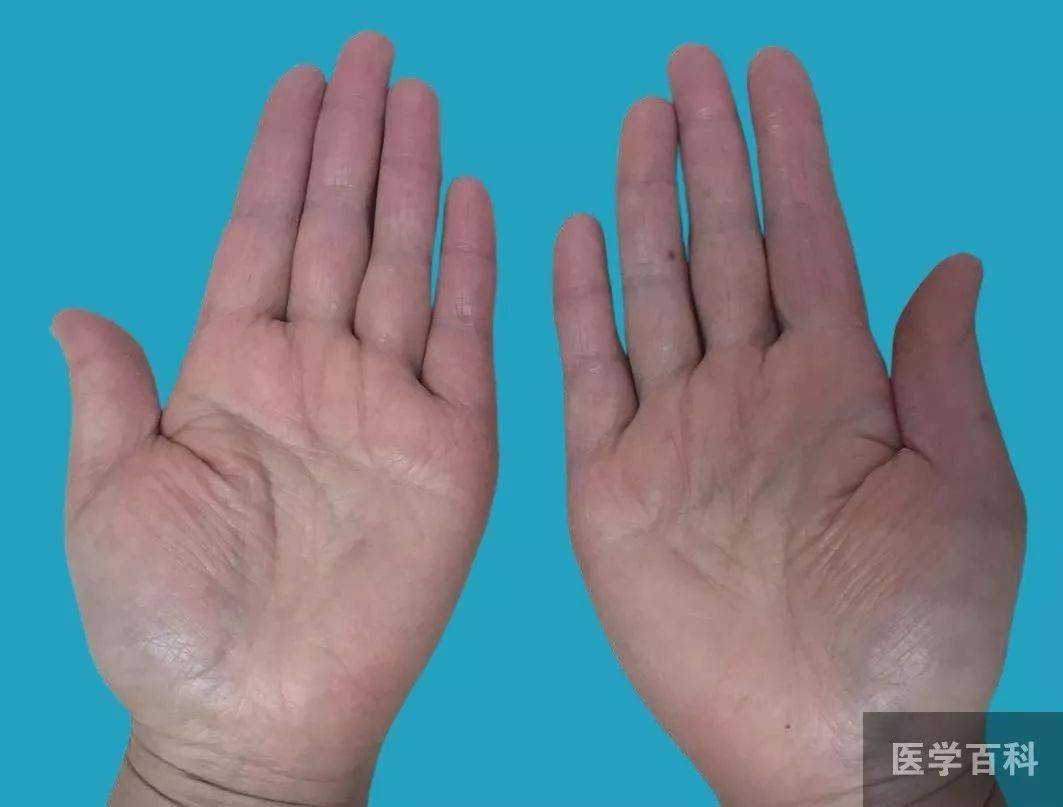 图解SLE | 雷诺现象-搜狐大视野-搜狐新闻