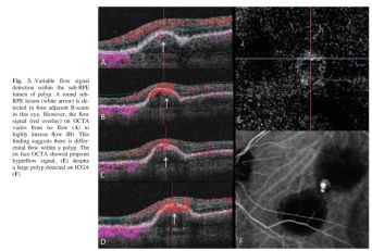 OCTA能筛查出PCV患者吗？-搜狐大视野-搜狐新闻