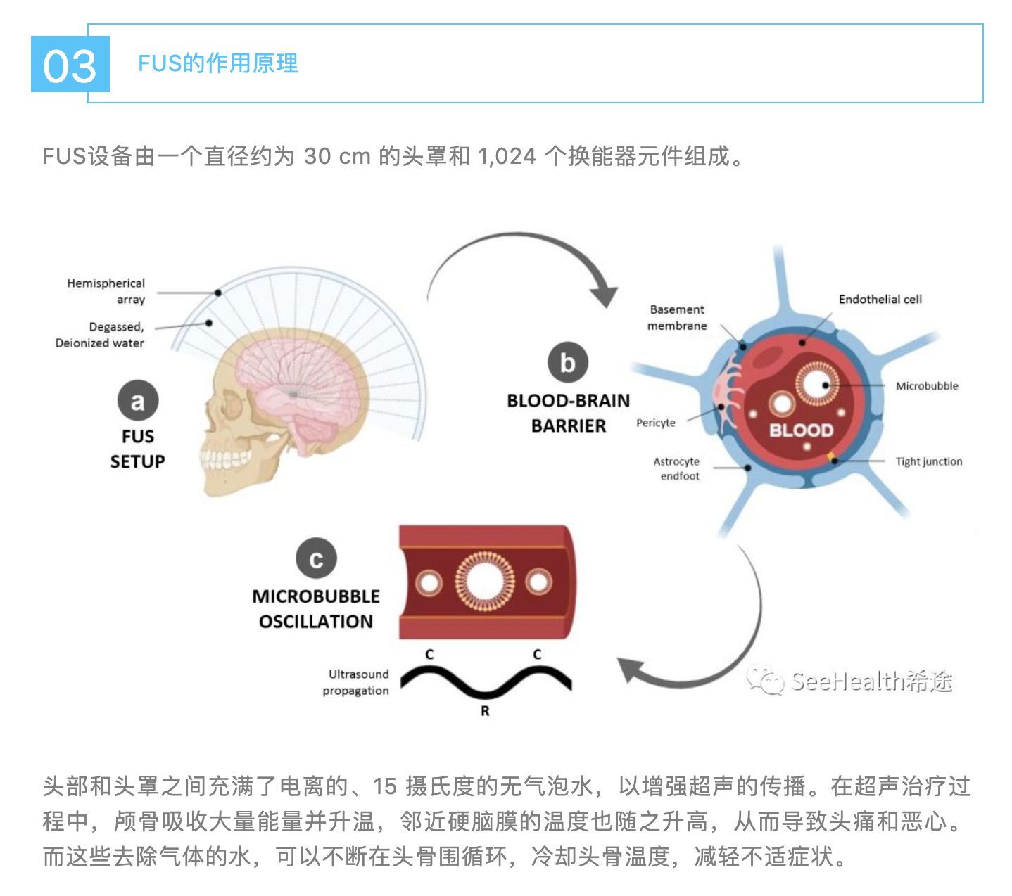 如何突破血脑屏障 新技术聚焦超声fus了解一下