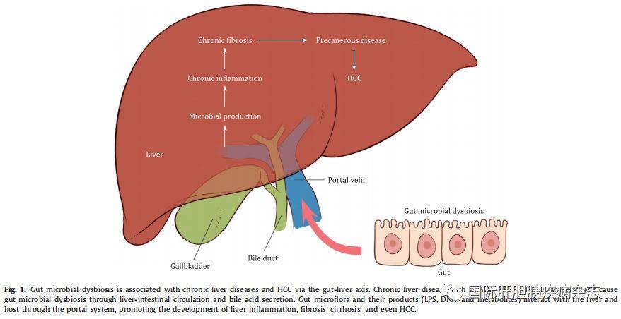 Hepatobiliary Pancreat Dis Int丨肠道微生态失衡通过肠轴介导与肝细胞癌相关-搜狐大视野-搜狐新闻