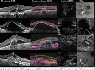 OCTA能筛查出PCV患者吗？-搜狐大视野-搜狐新闻