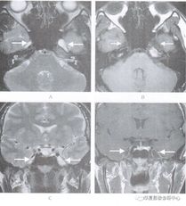【温故知新】梅克尔（Meckel）腔的影像解剖及临床意义-搜狐大视野-搜狐新闻