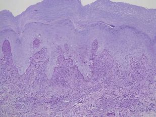 反向型 Gottron 征，你注意过吗？-搜狐大视野-搜狐新闻