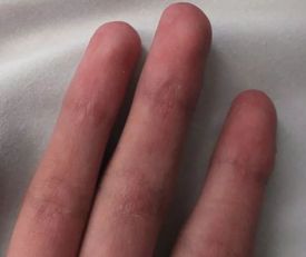 反向型 Gottron 征，你注意过吗？-搜狐大视野-搜狐新闻