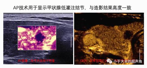 Angio Plus - 无创评估微灌注的好帮手-搜狐大视野-搜狐新闻