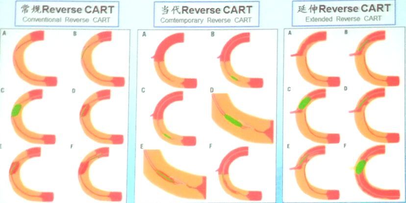 心讲座丨徐亚伟：何时使用Reverse CART？_病变