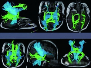 揭开DTI影像技术“神秘的面纱”,让手术变得更“精准”更“安全”_治疗