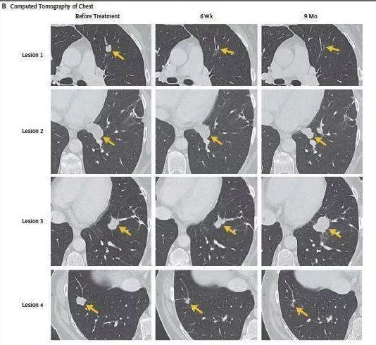[实体肿瘤, 值得期待]TIL免疫疗法获FDA突破性疗法认定-搜狐大视野-搜狐新闻