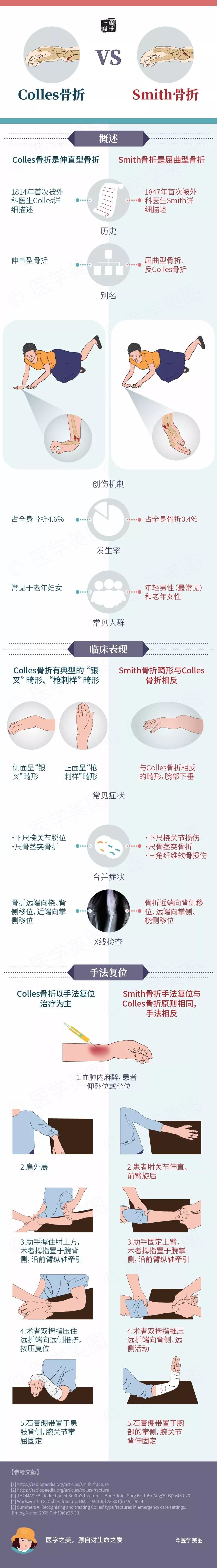 一图读懂丨Colles骨折、Smith骨折_急诊