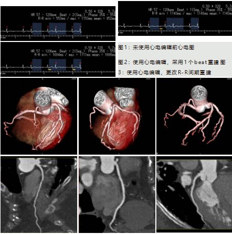 西电集团医院——佳能（东芝）第三代超高端640层镨黄金CT临床应用介绍_检查