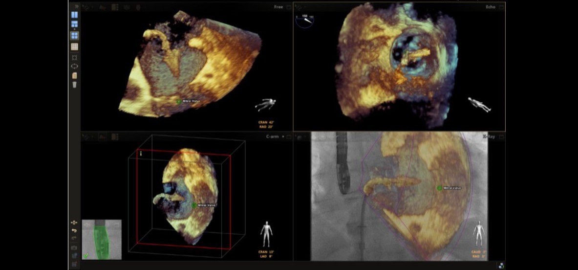 我院引进荷兰飞利浦DSA血管造影系统，技术设备再上新台阶！-搜狐大视野-搜狐新闻