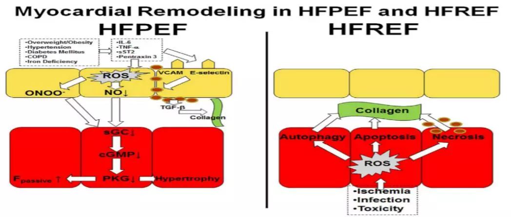CIHFC2019丨季晓平教授：同一个疾病，不同的类型——HFpEF病生理的异质性_治疗
