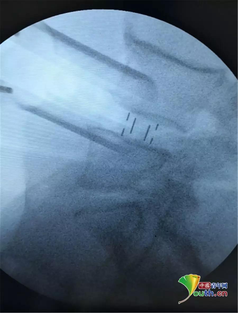 西安市红会医院完成西北首例“OLIF技术+骨科手术机器人”手术_腰椎