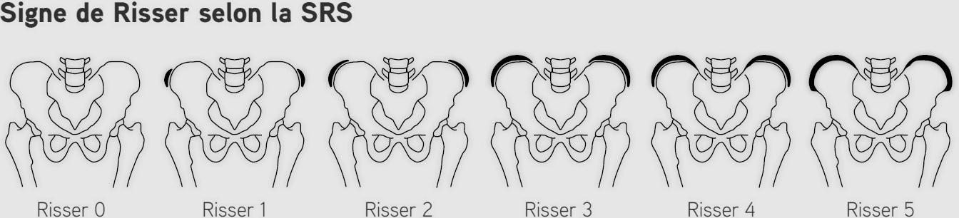 脊柱侧弯骨龄与X线检查_Risser