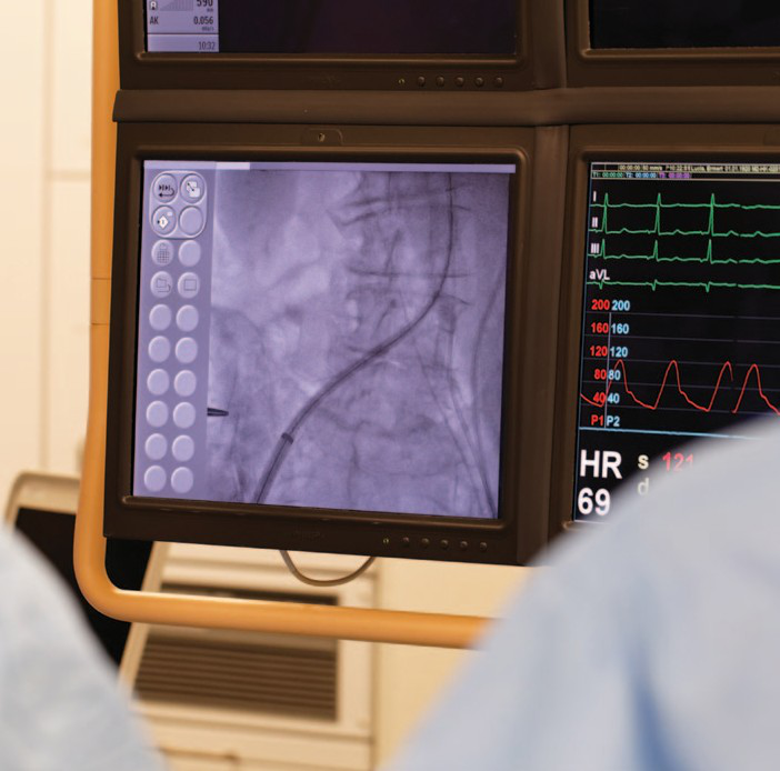 ACIST CVi血管造影注射系统在TAVI和TAVR手术中的应用_进行