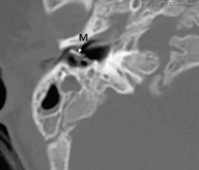 先天性内耳畸形的分类及影像学表现_Inner