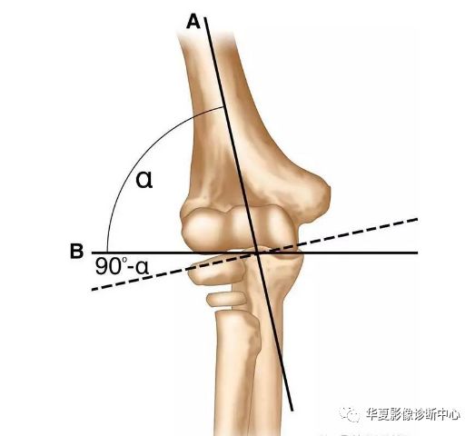 影像基础 肱骨髁上骨折 Gartland 分型 损伤