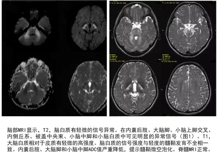 伴CLCN2基因突变的继发性PKD-搜狐大视野-搜狐新闻