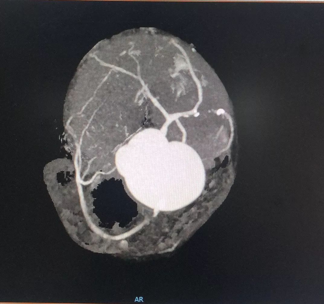 开通CTO，从冠状动脉CTA读图开始_血管
