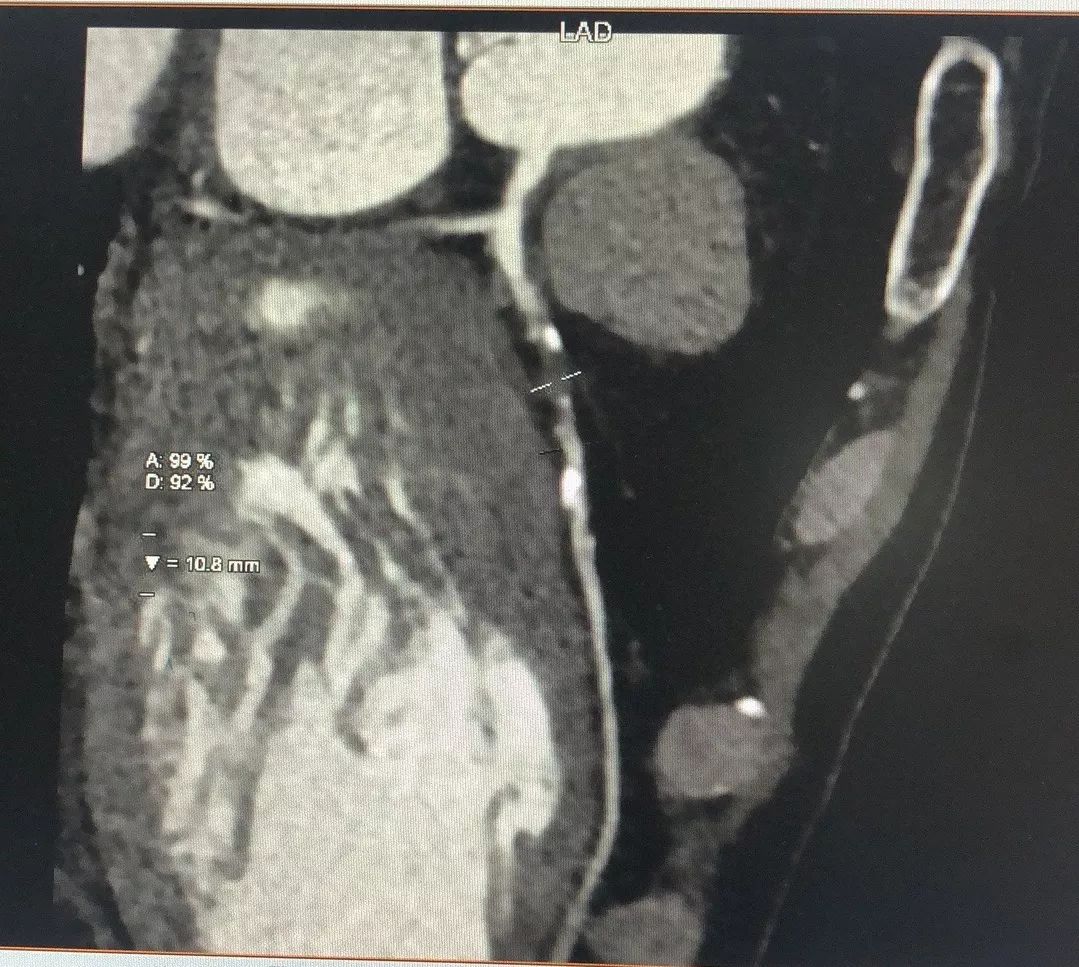 开通CTO，从冠状动脉CTA读图开始_血管
