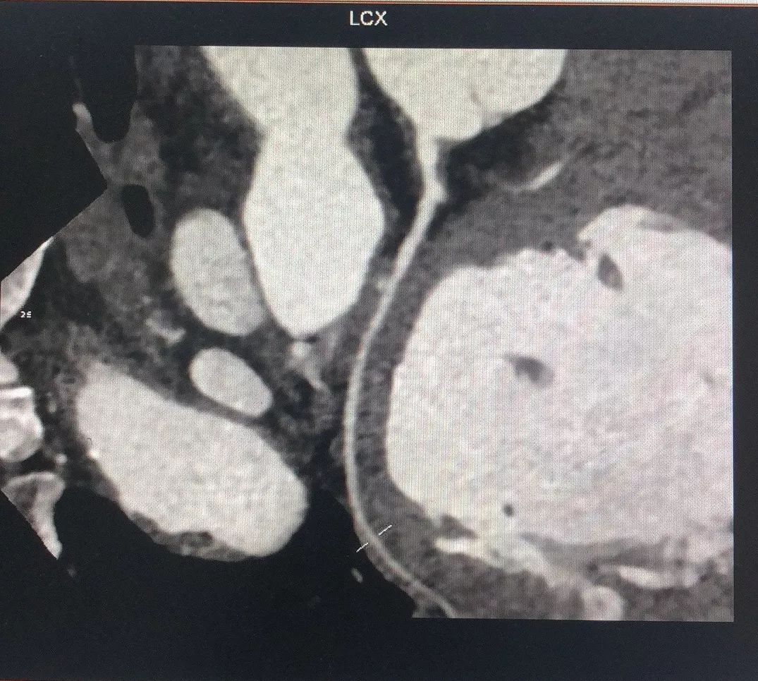 开通CTO，从冠状动脉CTA读图开始_血管