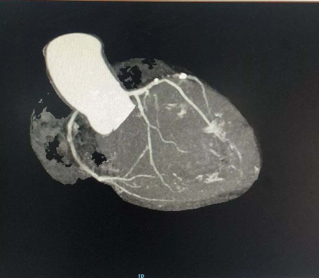 开通CTO，从冠状动脉CTA读图开始_血管