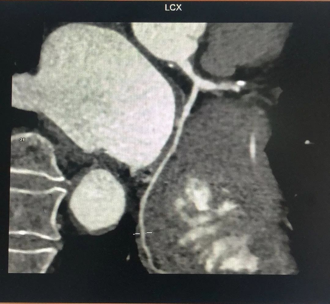 开通CTO，从冠状动脉CTA读图开始_血管