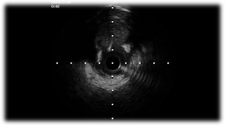 开通CTO，从冠状动脉CTA读图开始_血管