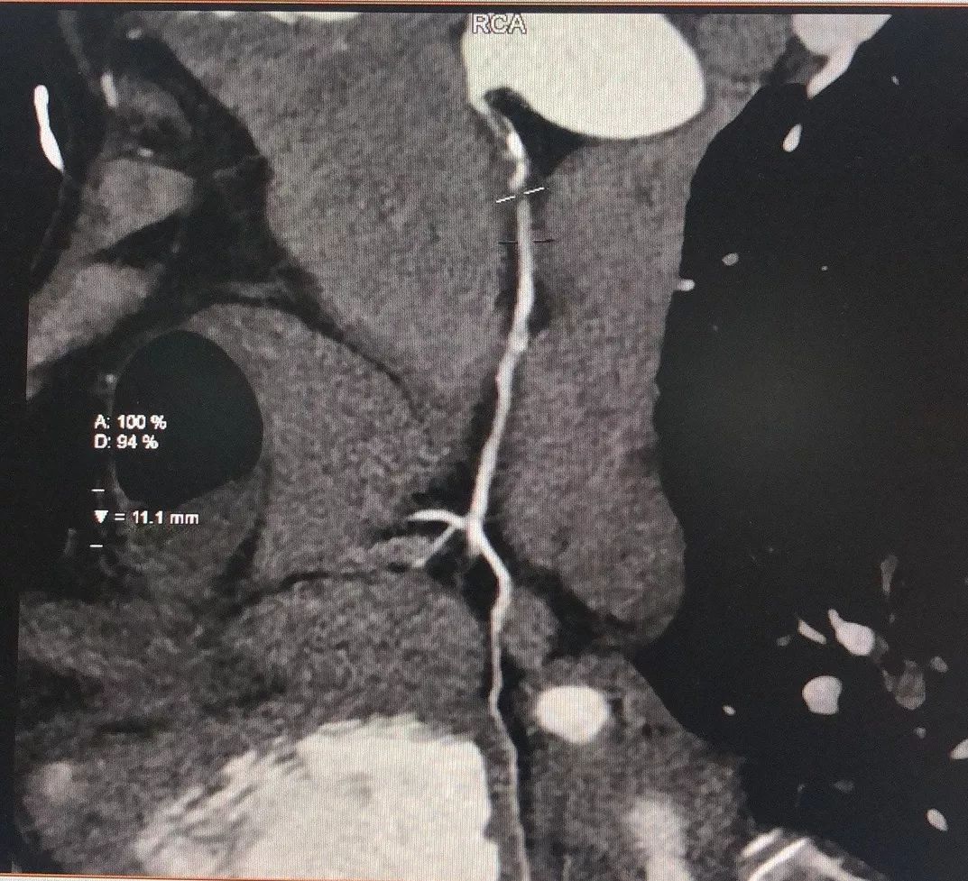 开通CTO，从冠状动脉CTA读图开始_血管