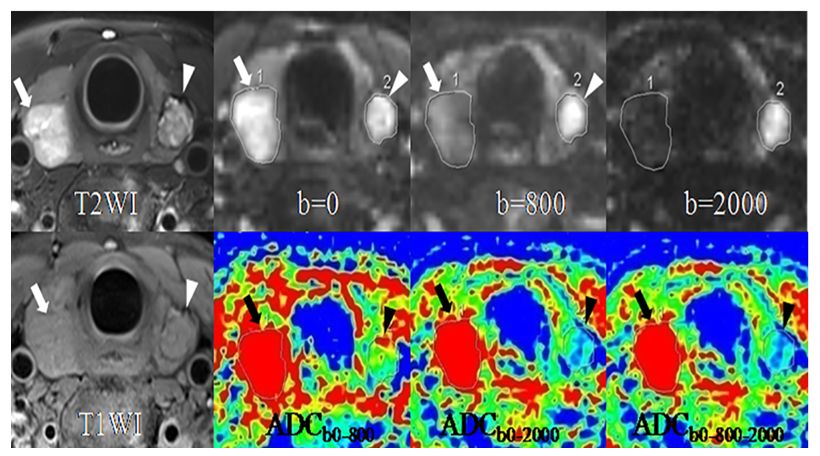 甲状腺高b值RESOLVE DWI解锁MRI新技能_诊断