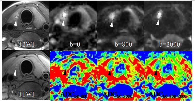 甲状腺高b值RESOLVE DWI解锁MRI新技能_诊断