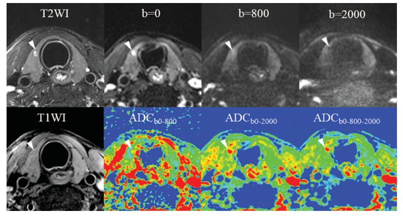 甲状腺高b值RESOLVE DWI解锁MRI新技能_诊断