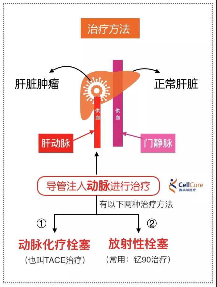 晚期肝脏恶性肿瘤治疗手段：TACE与SIRT治疗，孰优孰劣？_栓塞