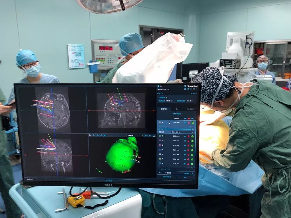 术精于准| 机器人辅助SEEG手术的优势在哪里 未来其应用范围会越来越广—浙医二院朱君明_电极