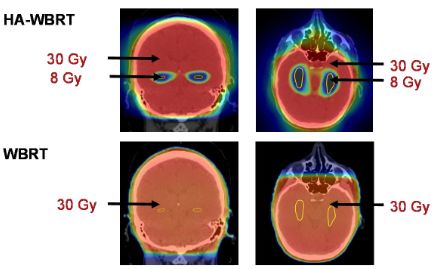 美金钢+海马保护性全脑放疗三期临床结果_患者