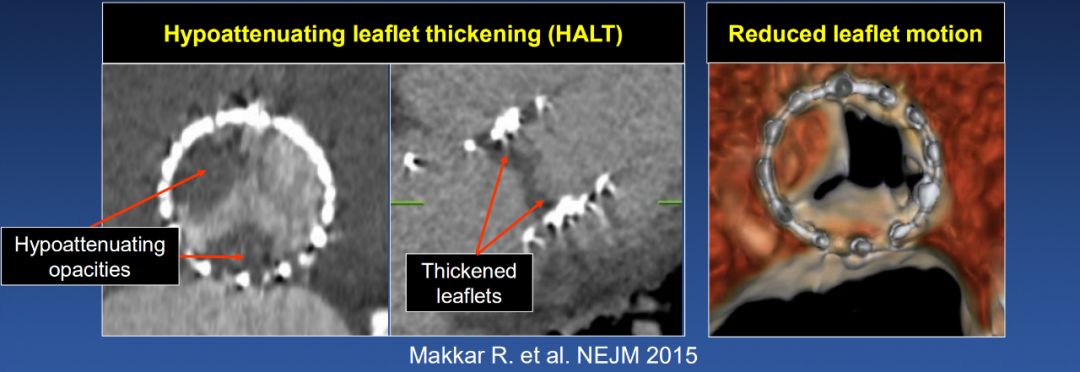 TCT 2019 | TAVR术后亚临床血栓发生率更高但不影响临床结局——PARTNER 3亚组研究结果公布_患者
