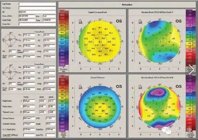 【眼科资讯】看完这10条，角膜地形图分析不再是难题！_散光