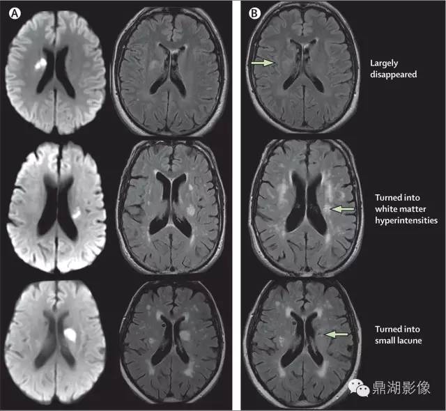 详细的脑小血管病影像诊断解读_病变