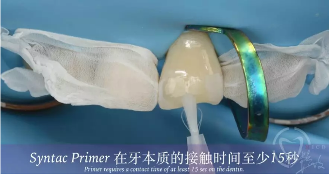 【医技沟通与协作】口腔1刻：一例局部瓷贴面的临床粘接流程_进行