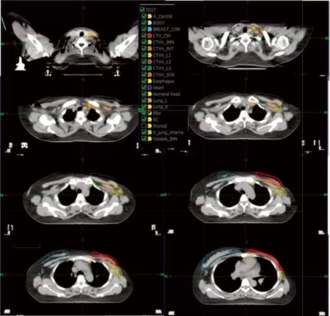 【指南与共识】| 早期乳腺癌术后靶区勾画共识_breast