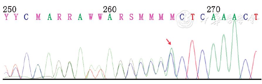 【病例报告】WAC基因致病性变异致DeSanto-Shinawi综合征伴睡眠期癫痫性电持续状态一例_患儿