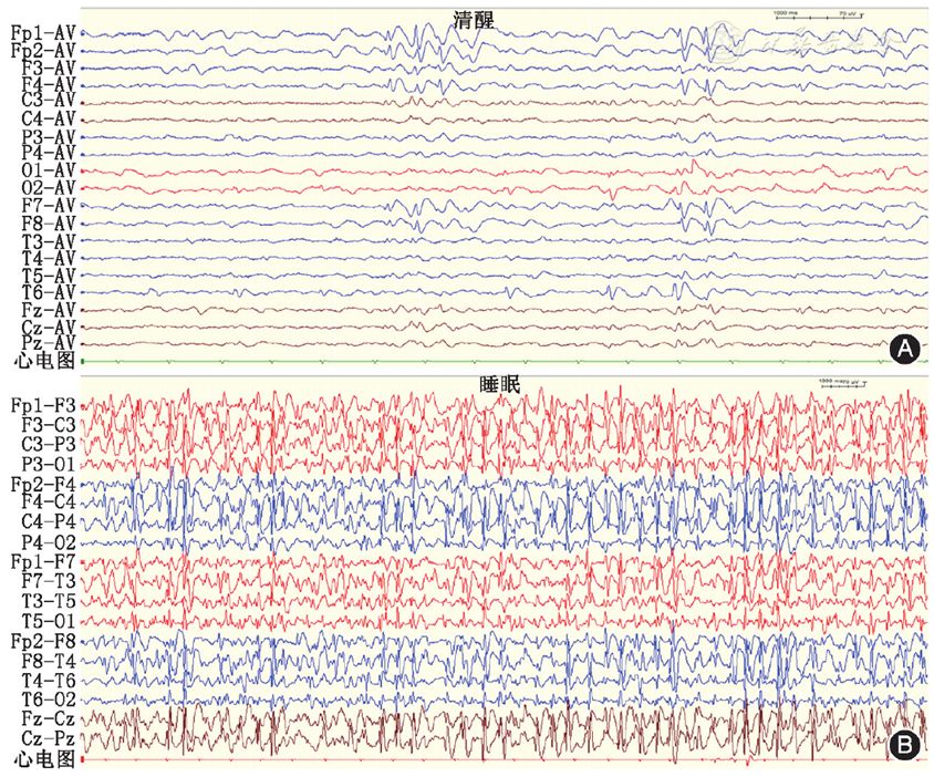 【病例报告】WAC基因致病性变异致DeSanto-Shinawi综合征伴睡眠期癫痫性电持续状态一例_患儿