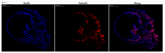 揭秘高度近视背后的遗传密码--协和眼科团队发现高度近视新基因TNFRSF21_患者