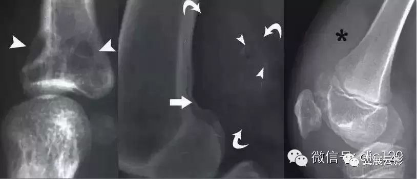 色素沉着绒毛结节滑膜炎（PVNS）_病变