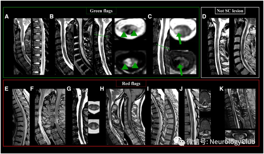 神经指南：多发性硬化MRI病灶评估_诊断