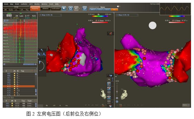郑州市九院成功开展Carto3三维标测系统房颤绿色射频消融术_患者