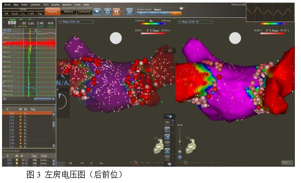 郑州市九院成功开展Carto3三维标测系统房颤绿色射频消融术_患者