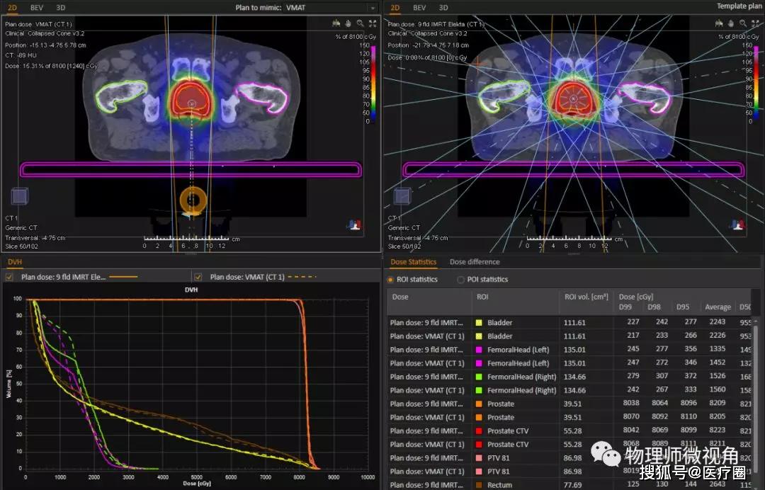 RayStation治疗计划系统综述_China