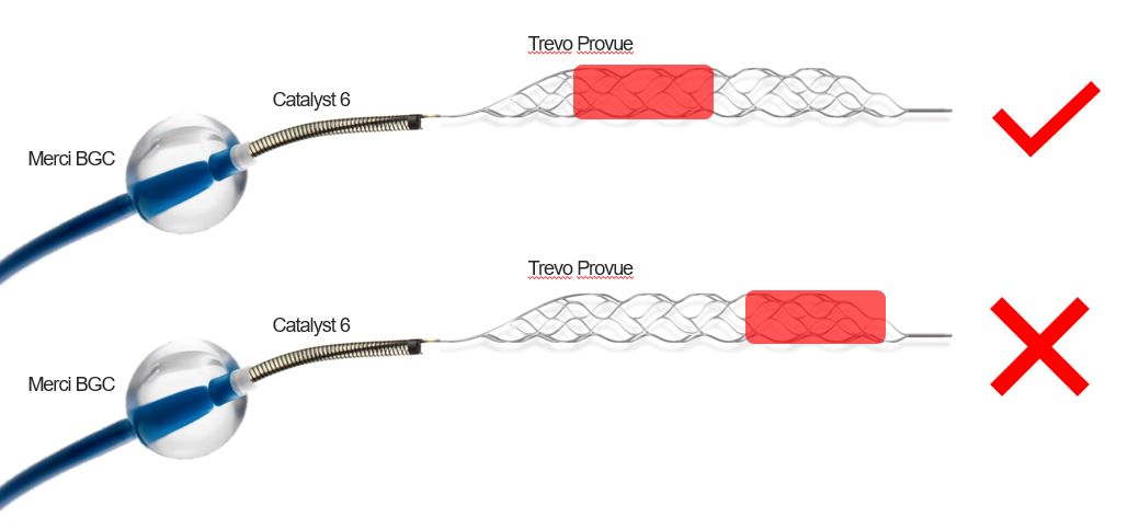 术说丨“细微之处见精神，毫厘之间定乾坤”——浅谈急性卒中支架取栓的几个技术细节_血栓