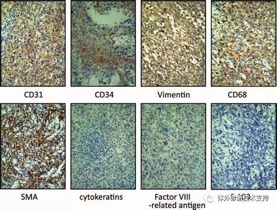 免疫组化&病理诊断_肿瘤
